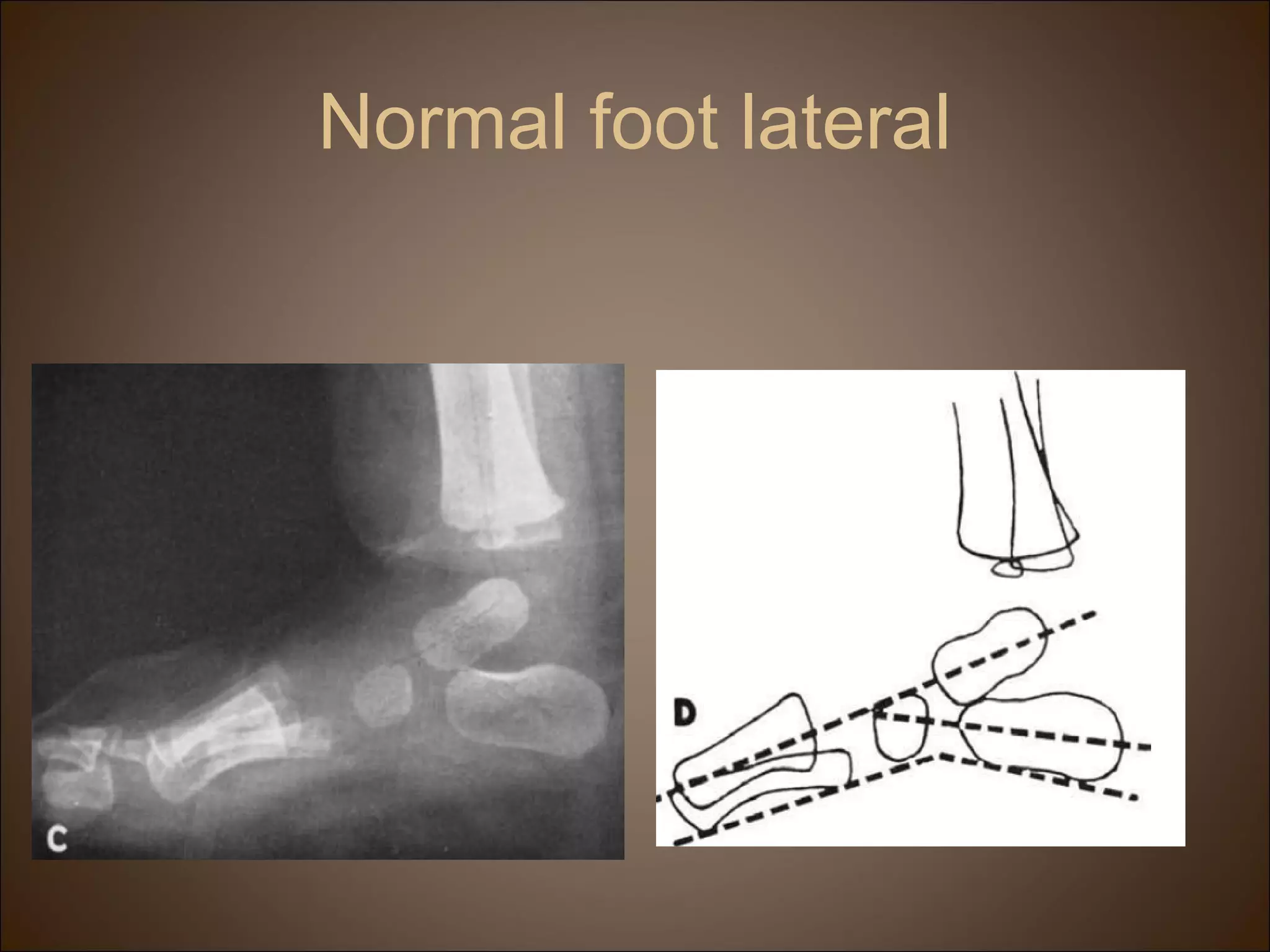 Club foot deformity | PPT