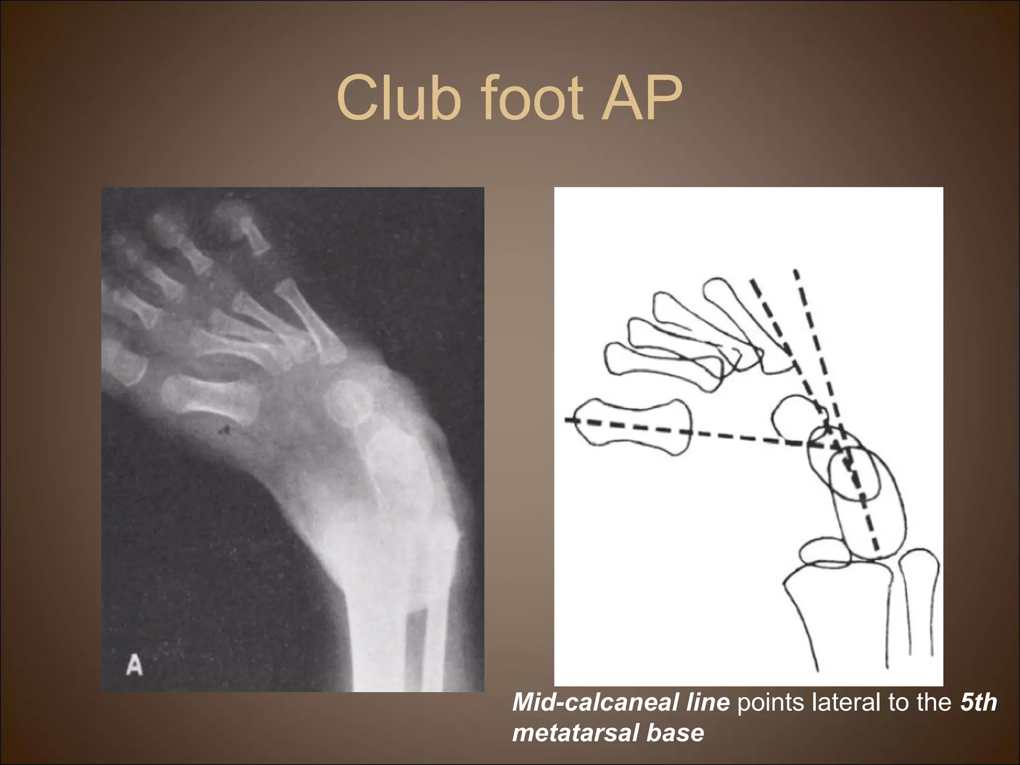 Club foot deformity | PPT