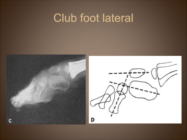 Club foot deformity | PPT