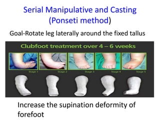 Ponseti Method Manipulation