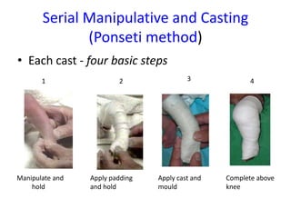 Ponseti Method Manipulation