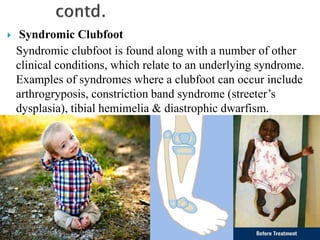 clubfoot ppt.pptx