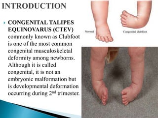 clubfoot ppt.pptx