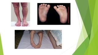 club foot ppt.pptx
