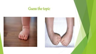 club foot ppt.pptx