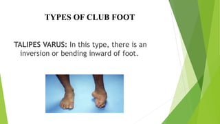 club foot ppt.pptx
