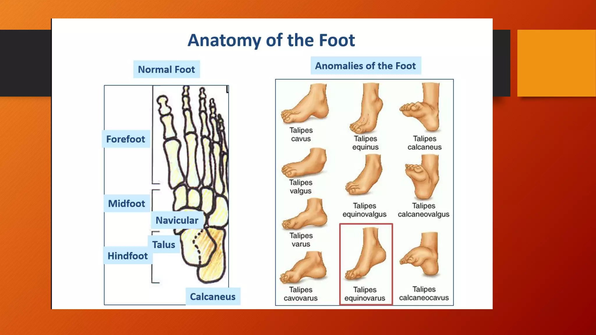 CLUB FOOT PRESENTATION.pptx