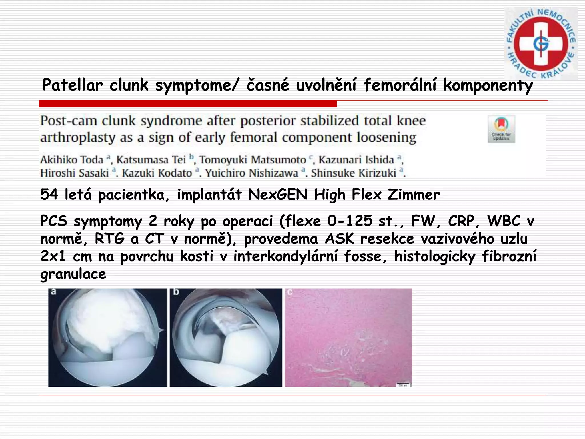 Patellar clunk syndrome | PPT