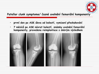 Patellar clunk syndrome | PPT