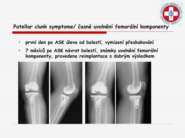 Patellar clunk syndrome | PPT