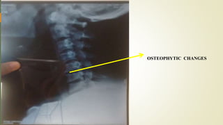 CASE PRESENTATION ON APABAHUKA (FROZEN SHOULDER) | PPTX