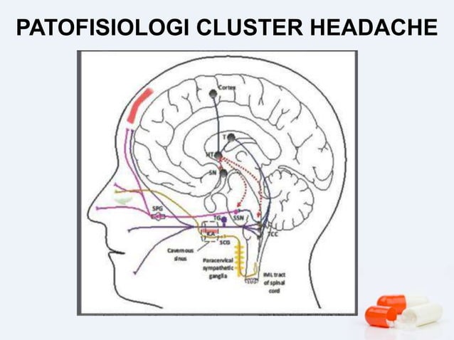 Cluster Headache dr. HM tugas.pptx
