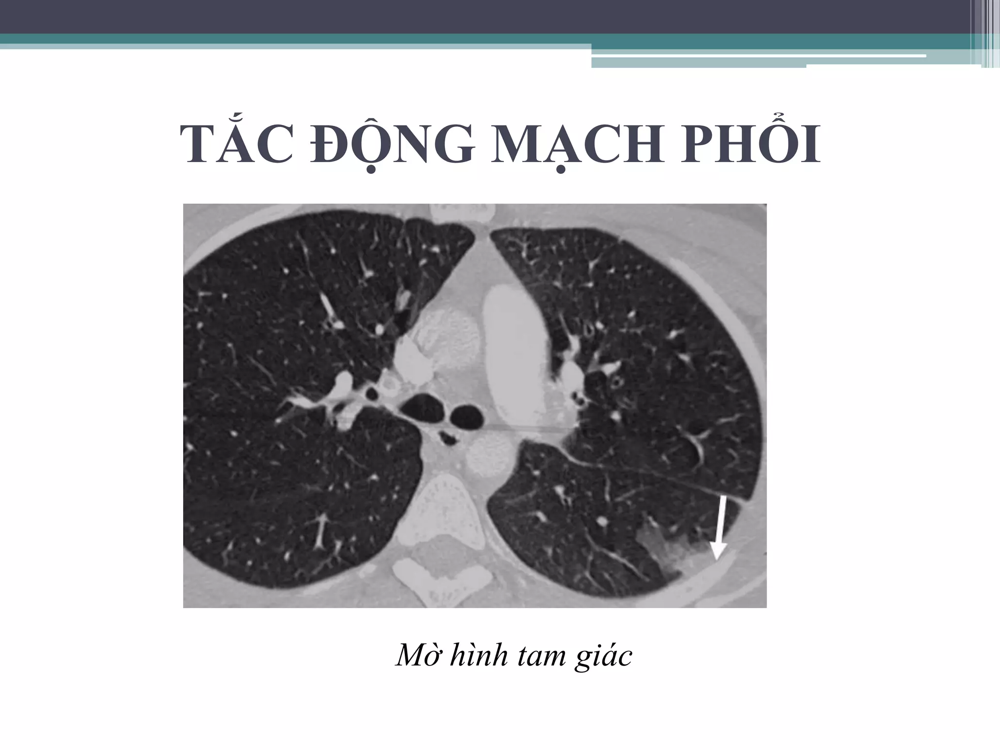 Clvt động mạch phổi | PPTX