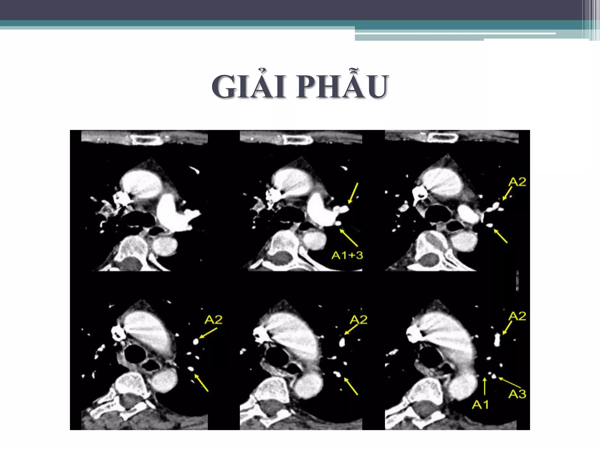 Clvt động mạch phổi | PPTX