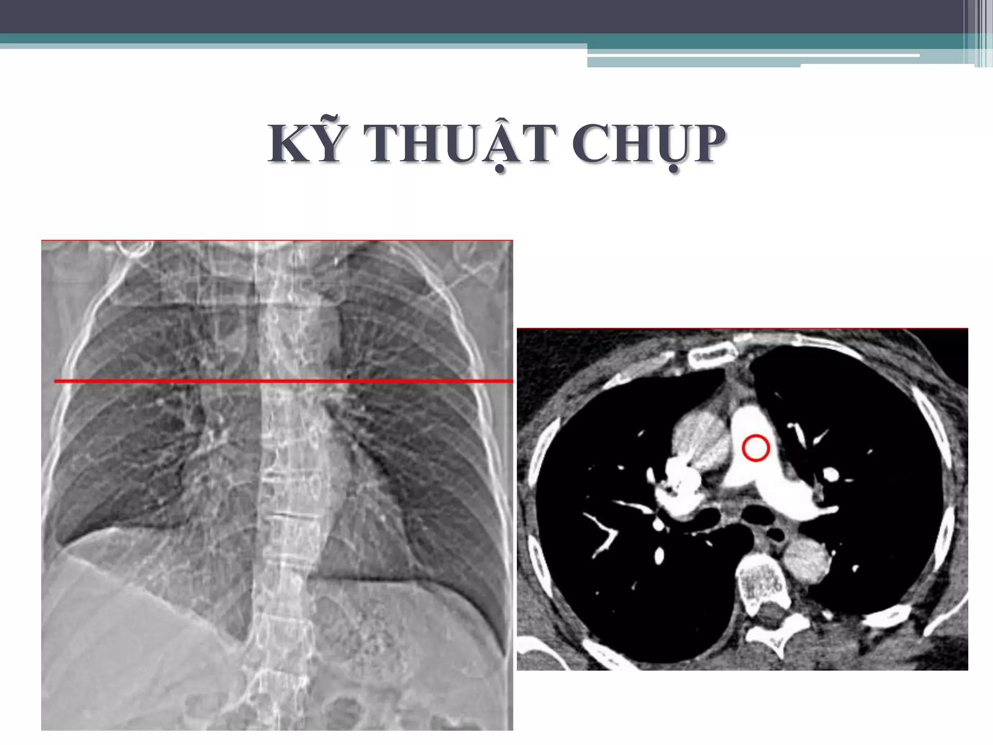 Radiologyhanoi.com CLVT mạch máu: Động mạch phổi | PPTX