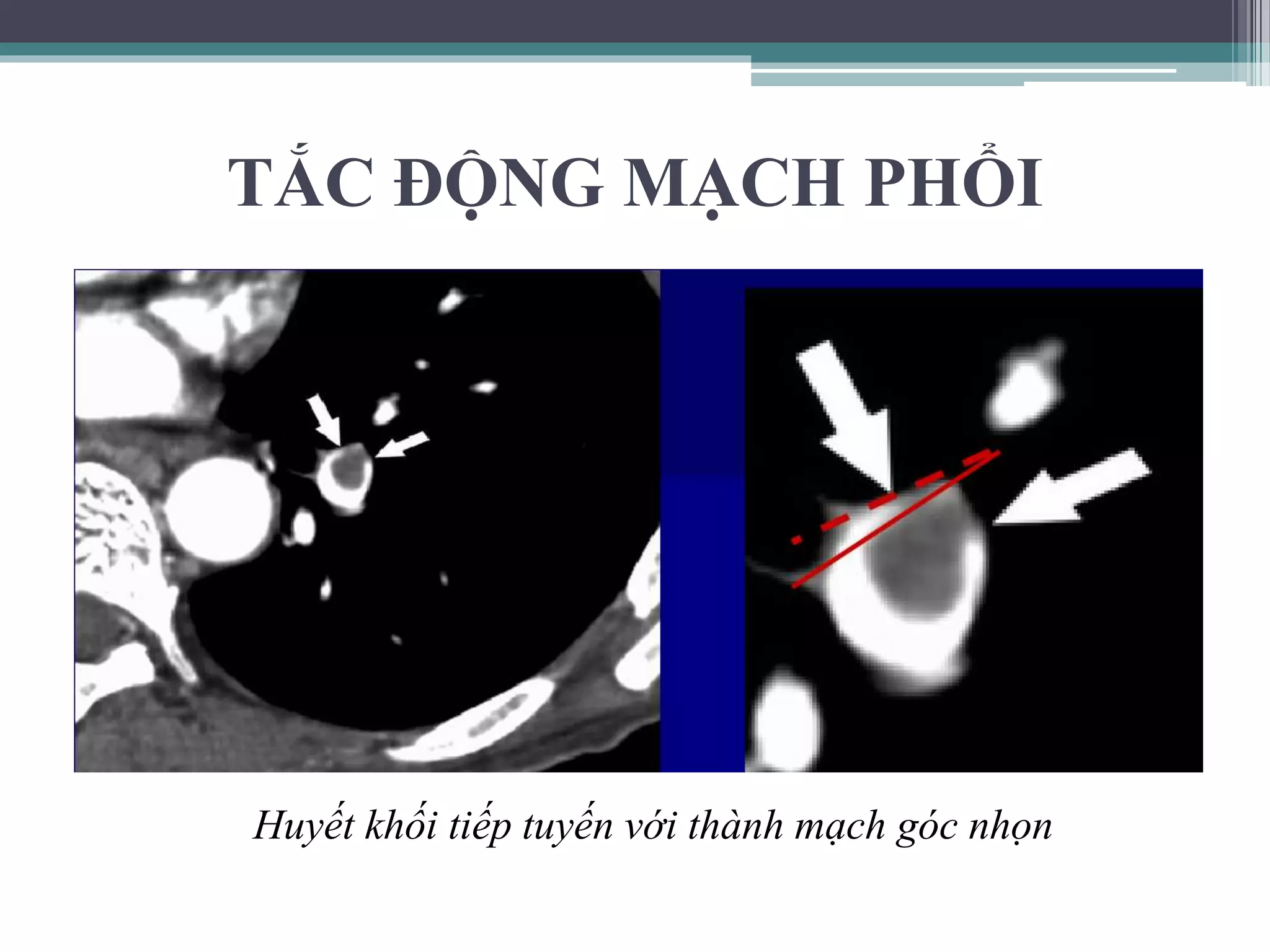 Radiologyhanoi.com CLVT mạch máu: Động mạch phổi | PPTX