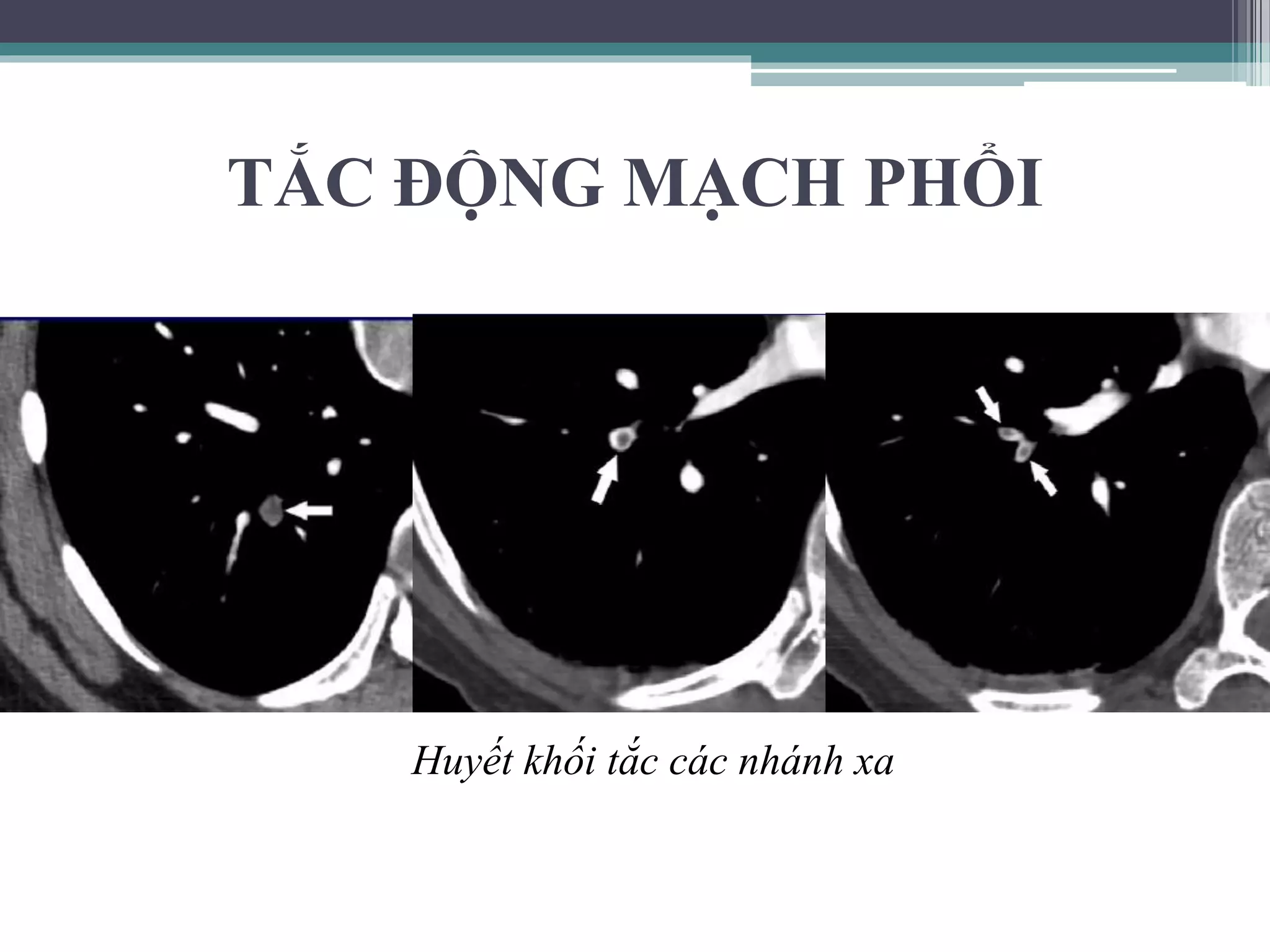 Radiologyhanoi.com CLVT mạch máu: Động mạch phổi | PPTX