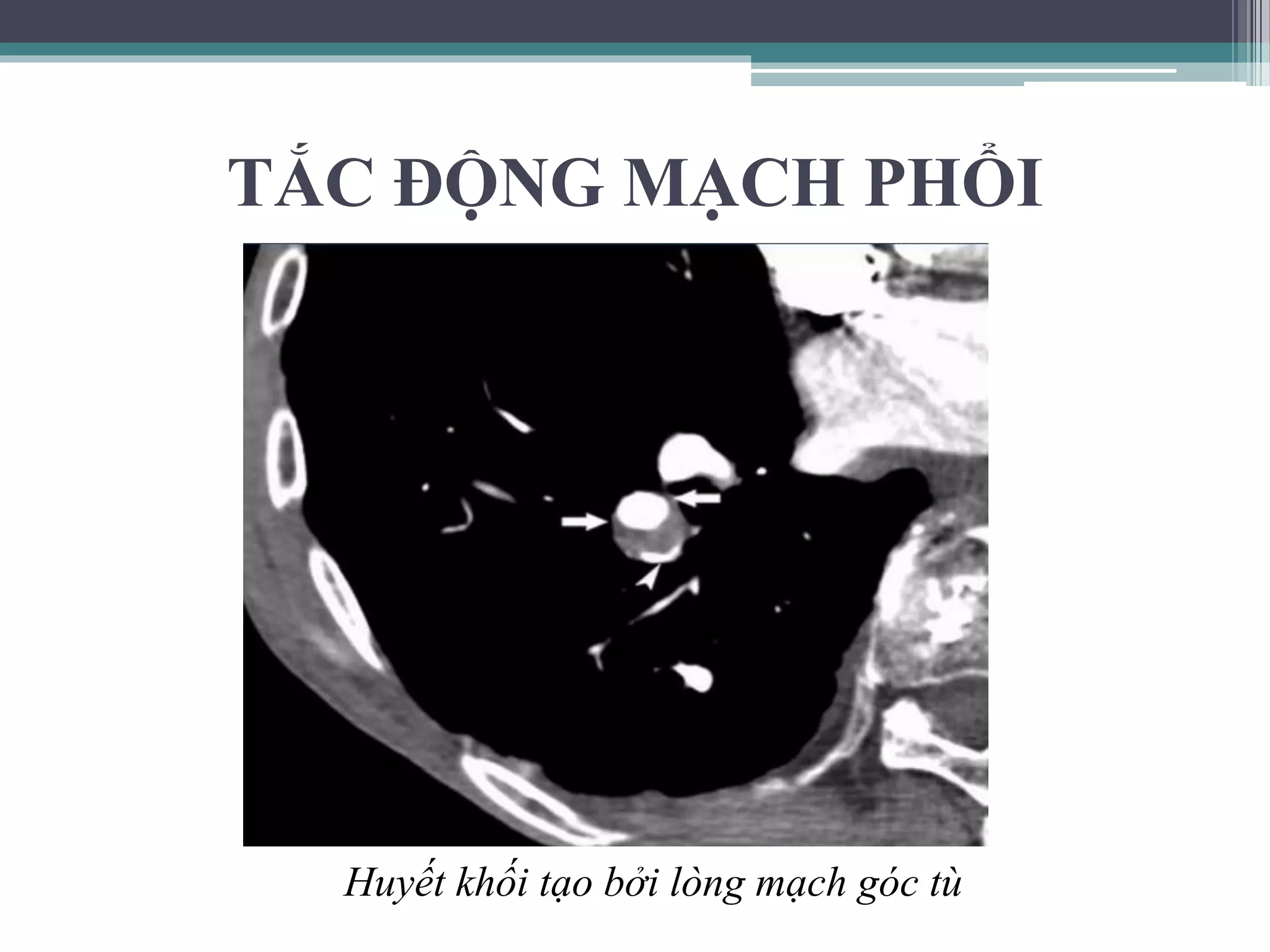 Radiologyhanoi.com CLVT mạch máu: Động mạch phổi | PPTX