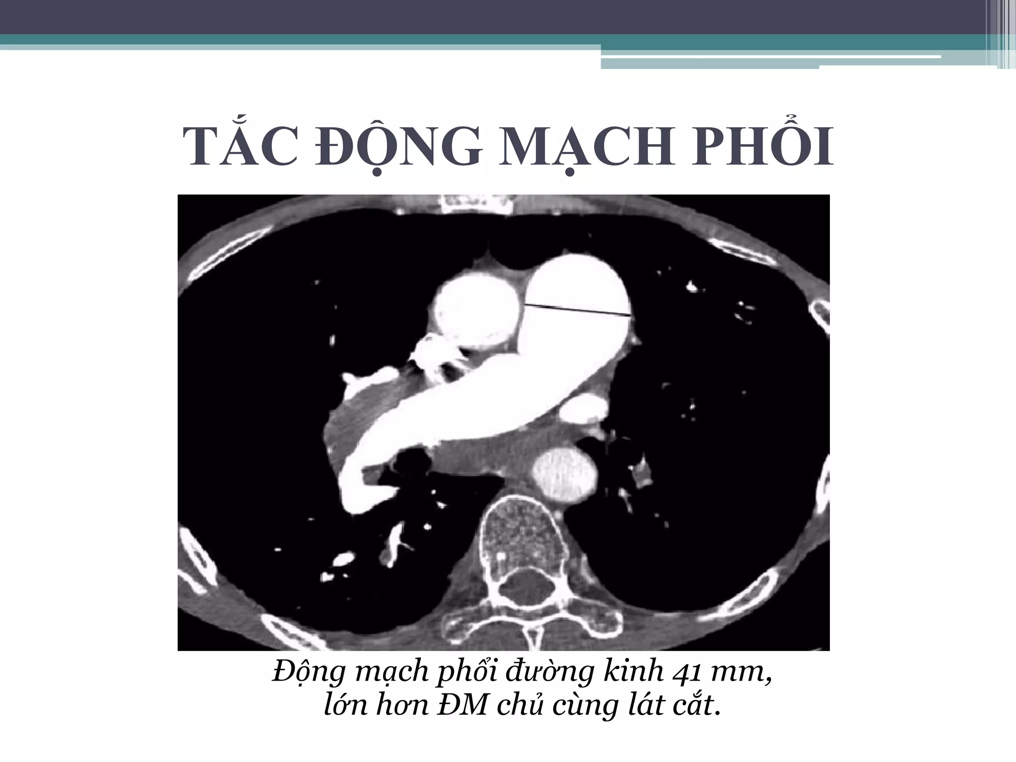Radiologyhanoi.com CLVT mạch máu: Động mạch phổi | PPTX