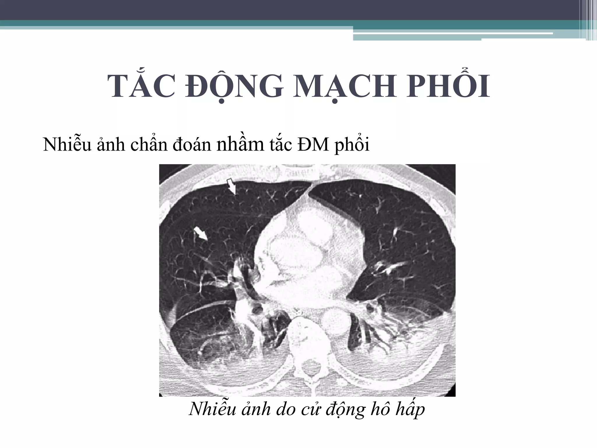 Radiologyhanoi.com CLVT mạch máu: Động mạch phổi | PPTX