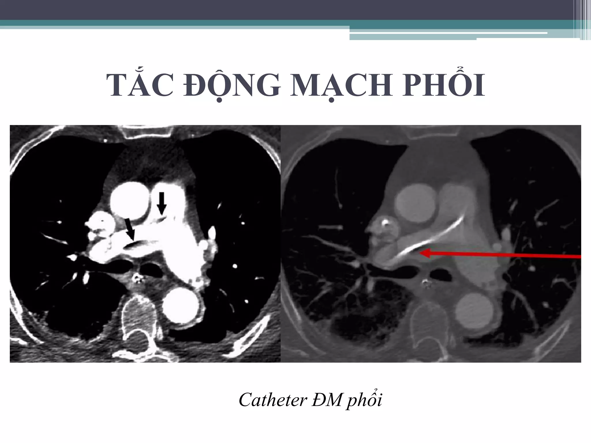 Radiologyhanoi.com CLVT mạch máu: Động mạch phổi | PPTX