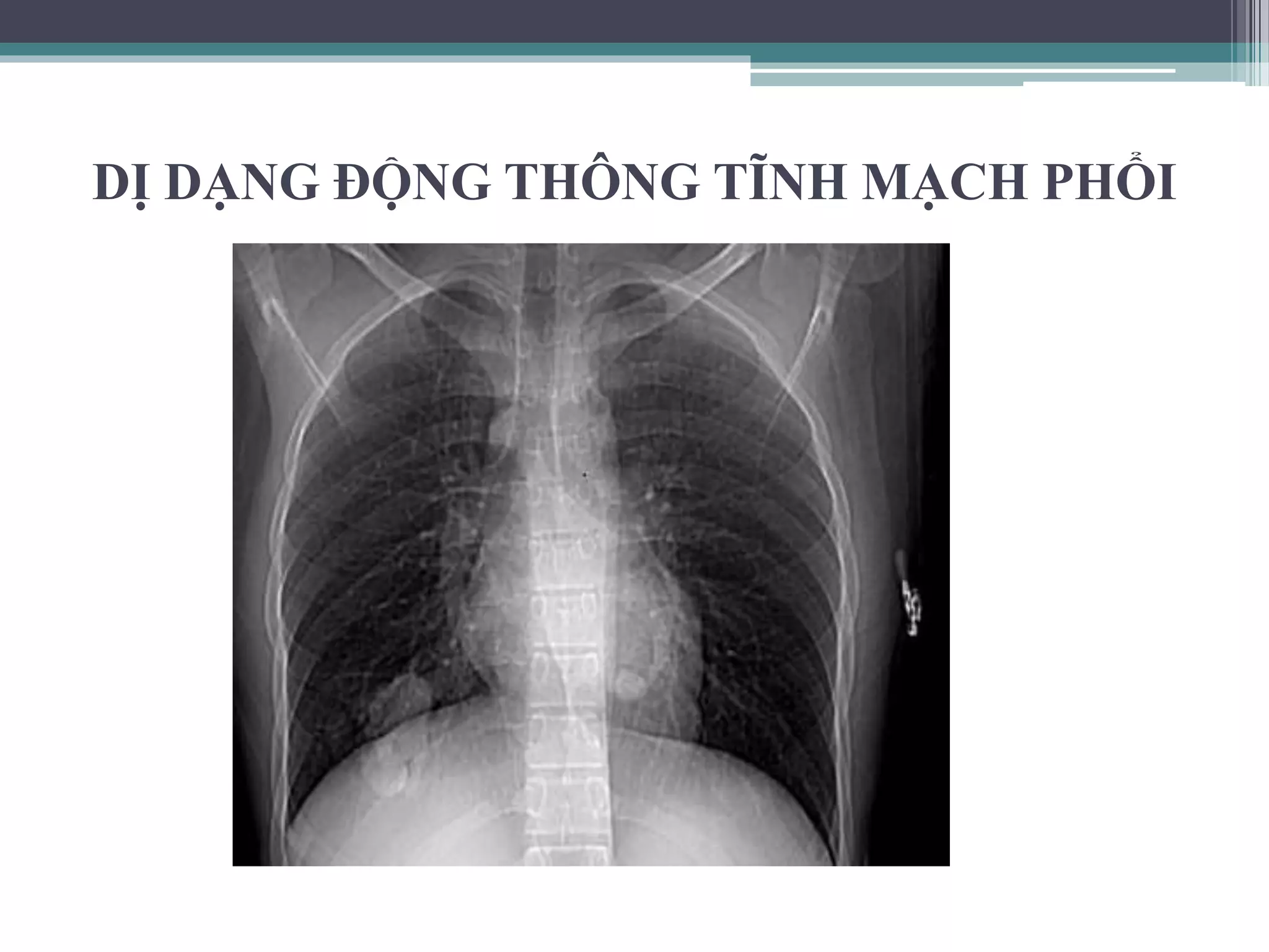 Radiologyhanoi.com CLVT mạch máu: Động mạch phổi | PPTX