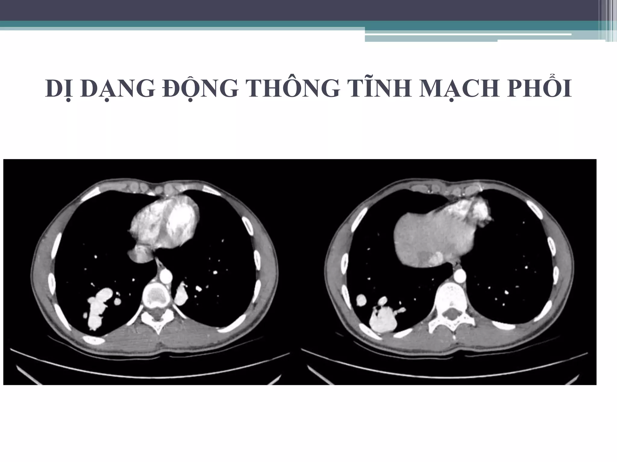 Radiologyhanoi.com CLVT mạch máu: Động mạch phổi | PPTX