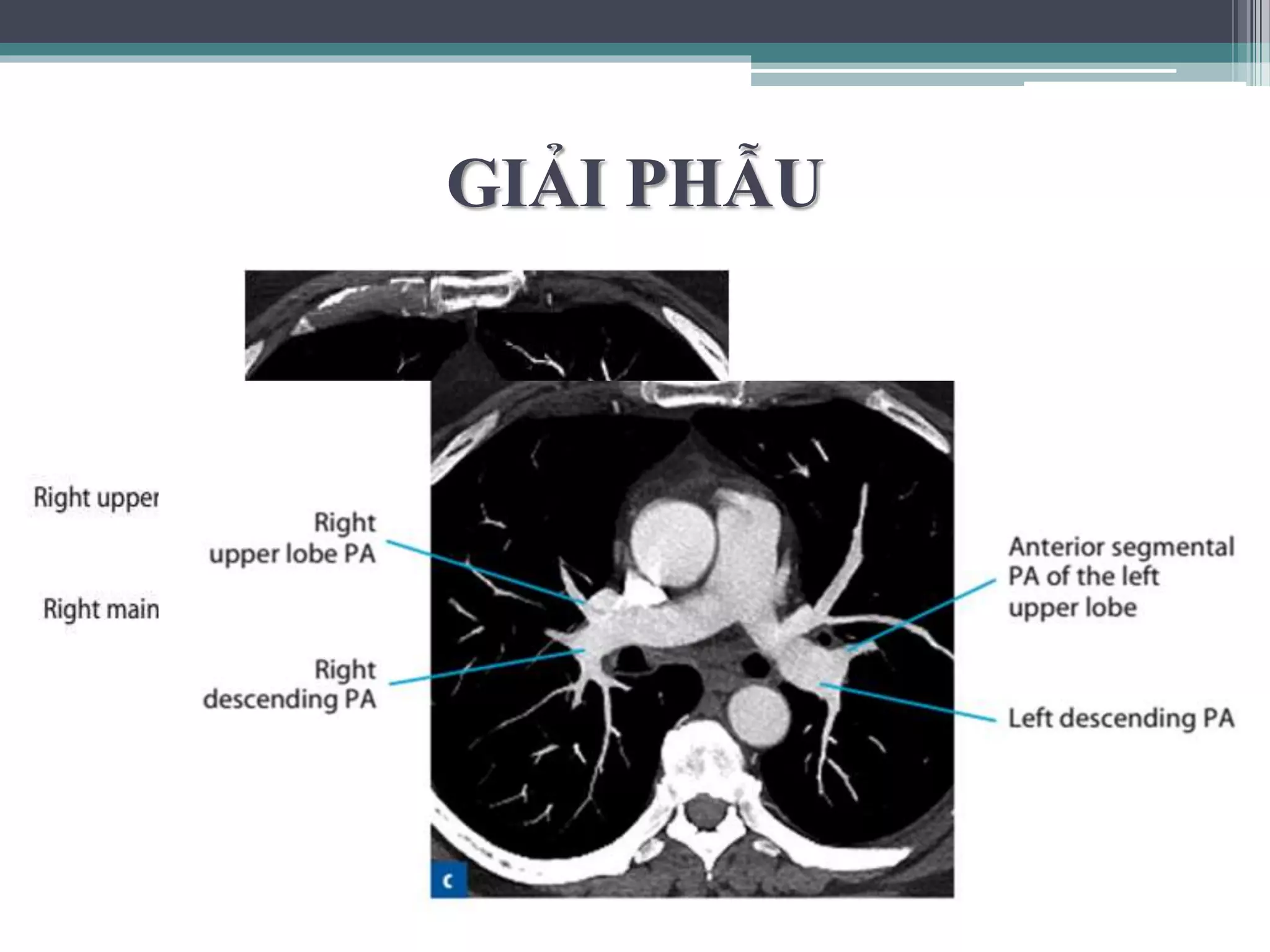 Radiologyhanoi.com CLVT mạch máu: Động mạch phổi | PPTX