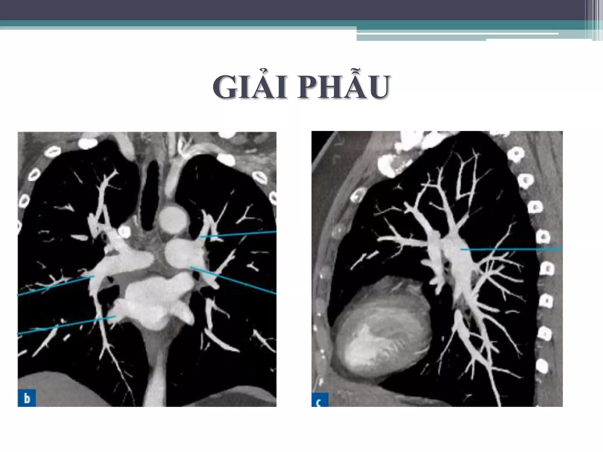 Radiologyhanoi.com CLVT mạch máu: Động mạch phổi | PPTX