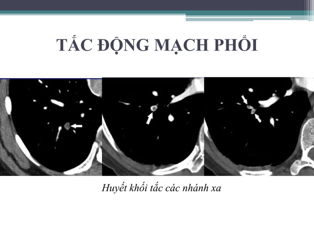 Radiologyhanoi.com CLVT mạch máu: Động mạch phổi | PPTX