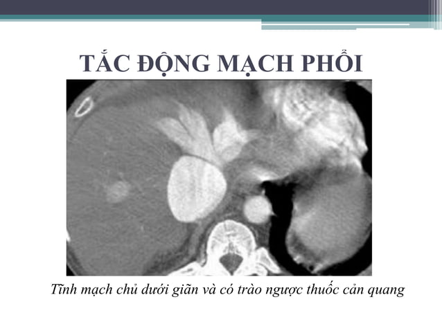 Radiologyhanoi.com CLVT mạch máu: Động mạch phổi | PPTX