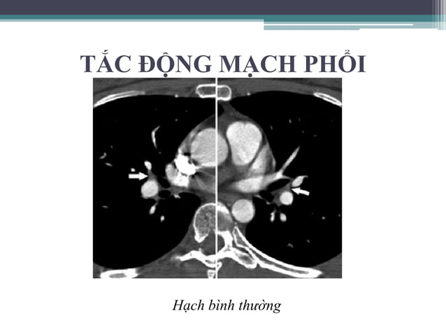 Radiologyhanoi.com CLVT mạch máu: Động mạch phổi | PPTX