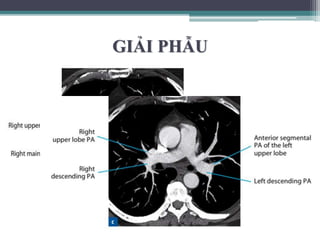 Radiologyhanoi.com CLVT mạch máu: Động mạch phổi | PPTX