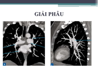 Radiologyhanoi.com CLVT mạch máu: Động mạch phổi | PPTX