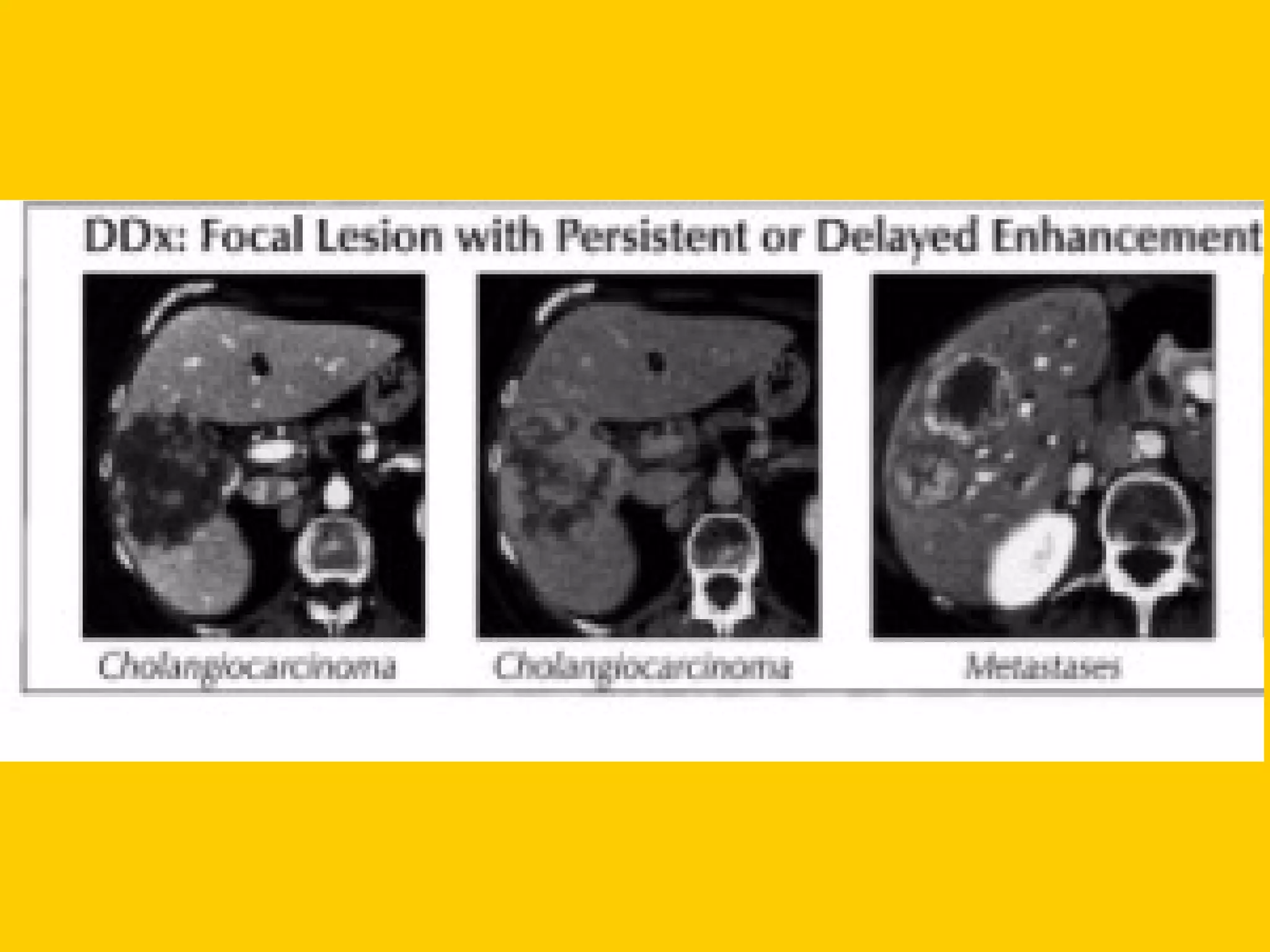 Clvt trong cđ u gan 1 | PPT
