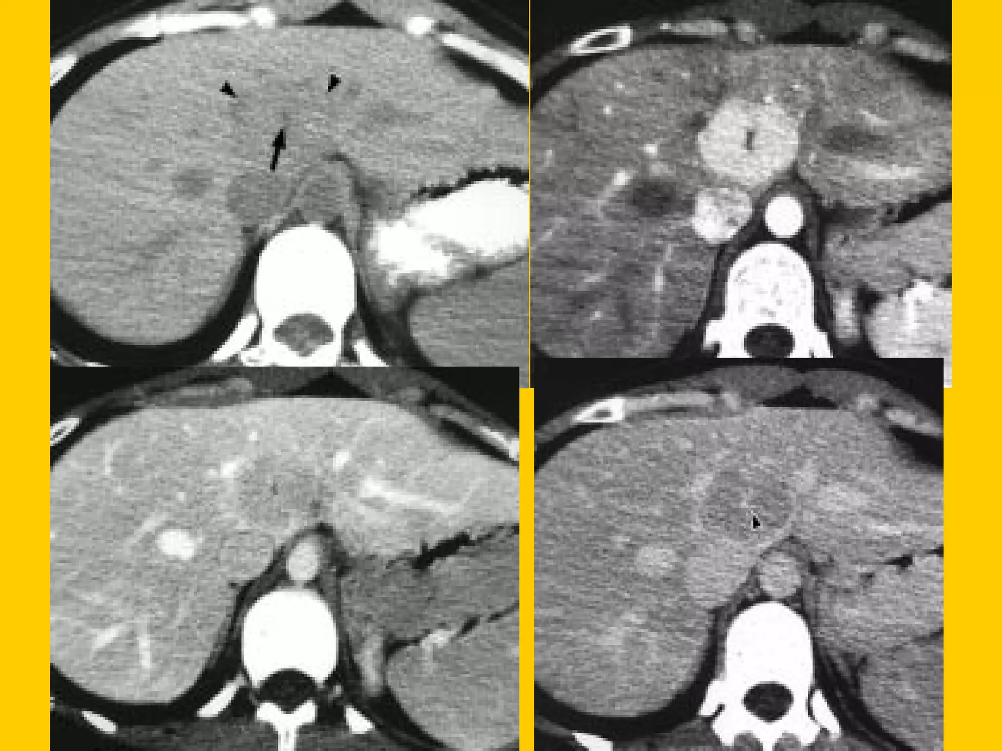 Clvt trong cđ u gan 1 | PPT
