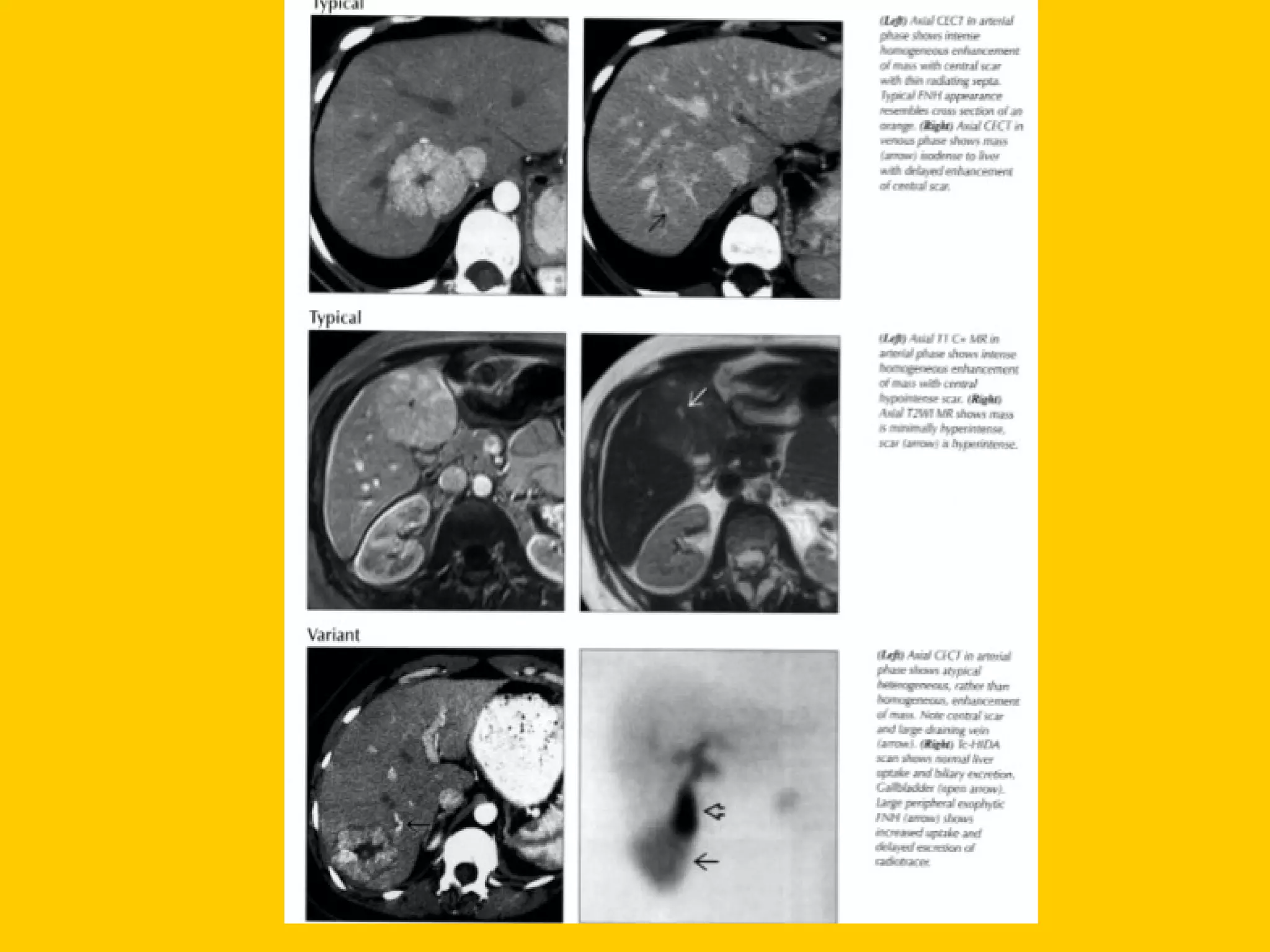 Clvt trong cđ u gan 1 | PPT
