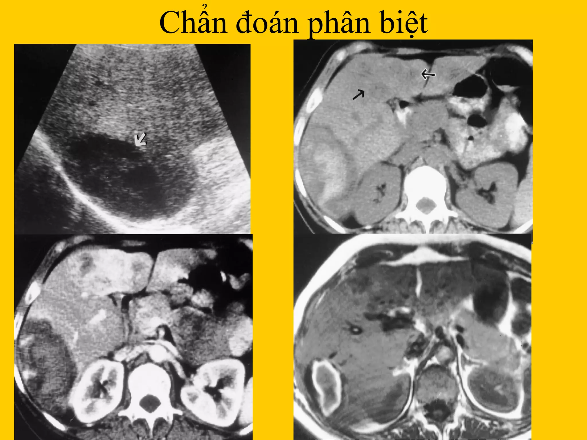 Clvt trong cđ u gan 1 | PPT