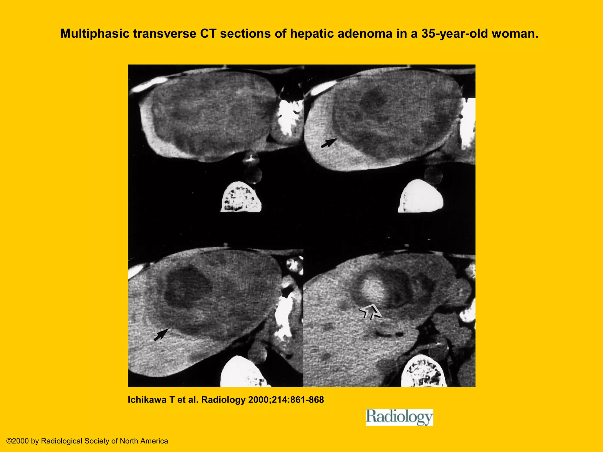 Clvt trong cđ u gan 1 | PPT