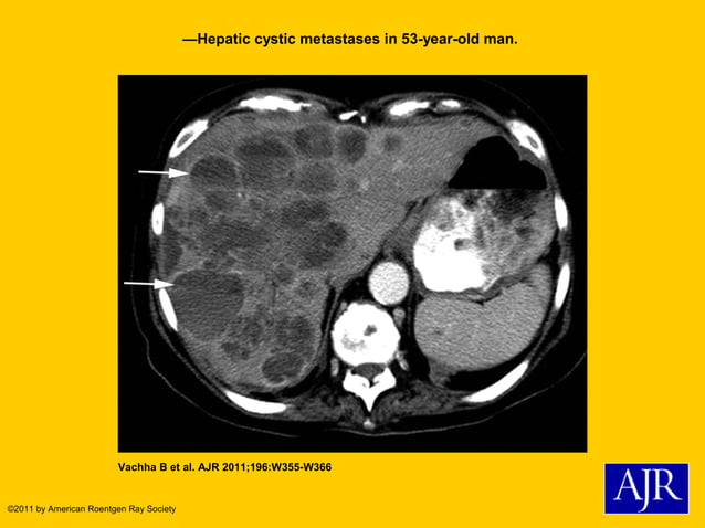 Clvt trong cđ u gan 1 | PPT