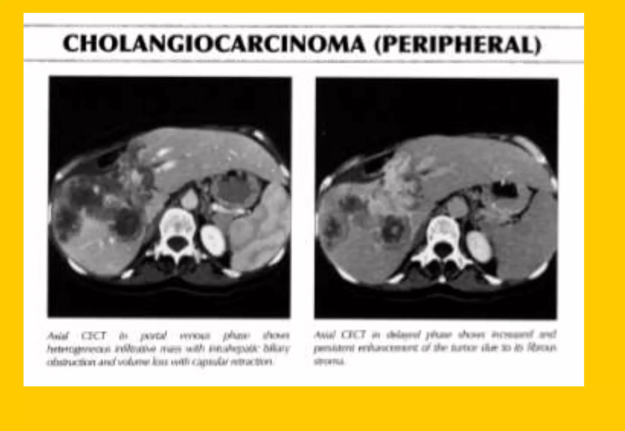 Clvt trong cđ u gan 2 | PPT