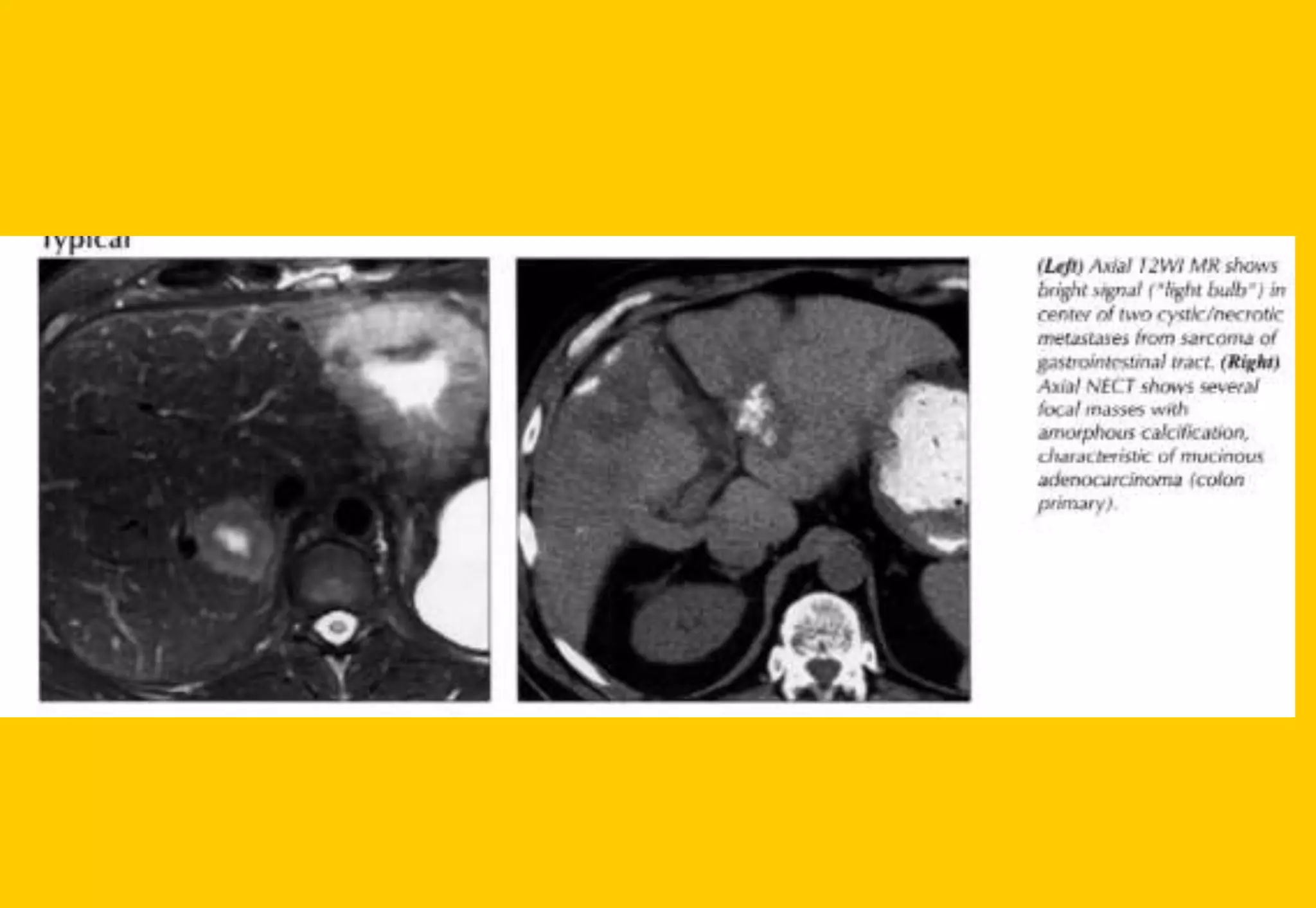 Clvt trong cđ u gan 2 | PPT
