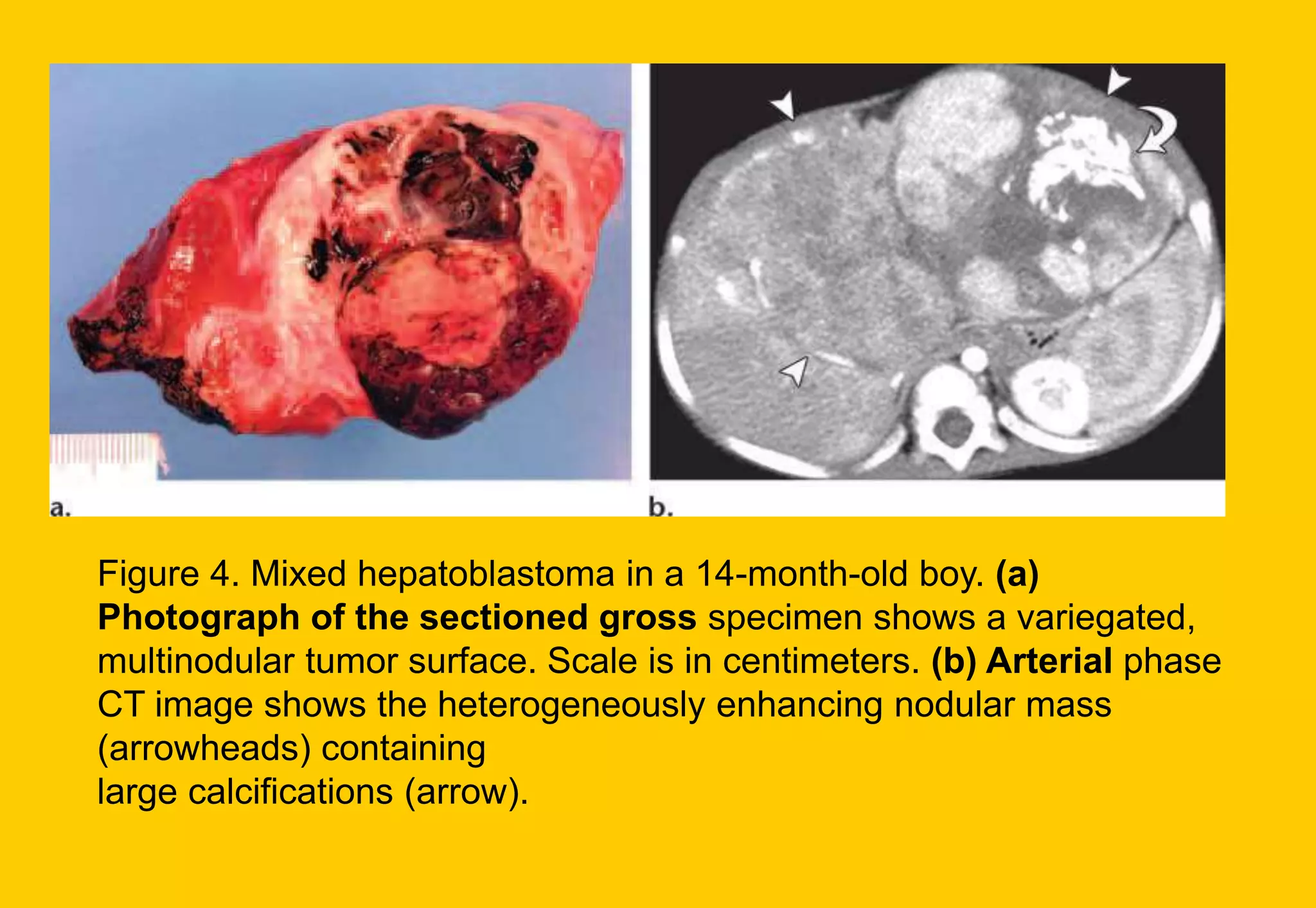 Clvt trong cđ u gan 2 | PPT