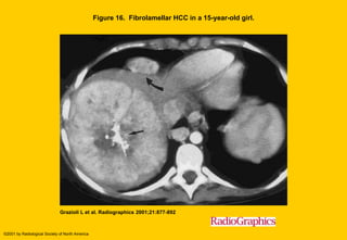 Clvt trong cđ u gan 2 | PPT
