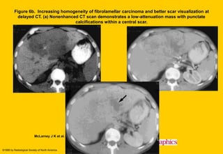 Clvt trong cđ u gan 2 | PPT
