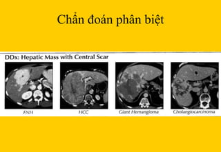 Clvt trong cđ u gan 2 | PPT