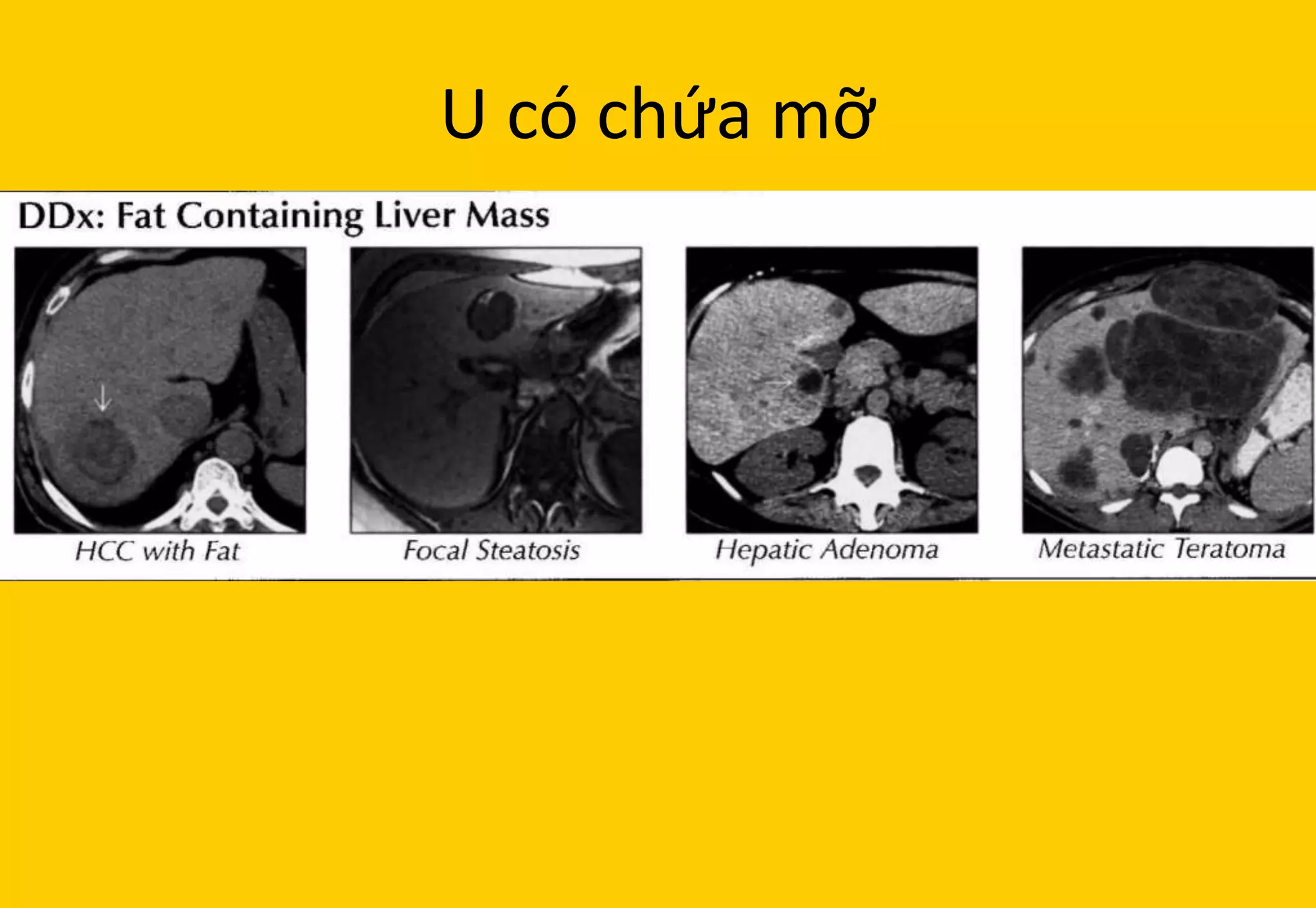 Clvt trong cđ u gan 2 | PPTX