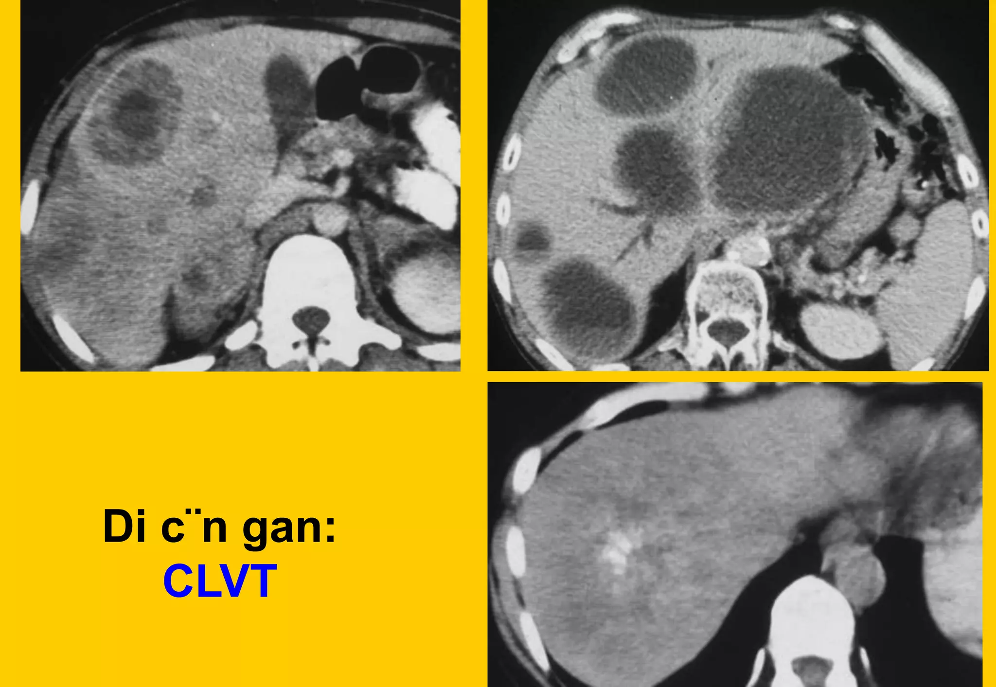 Clvt trong cđ u gan 2 | PPTX