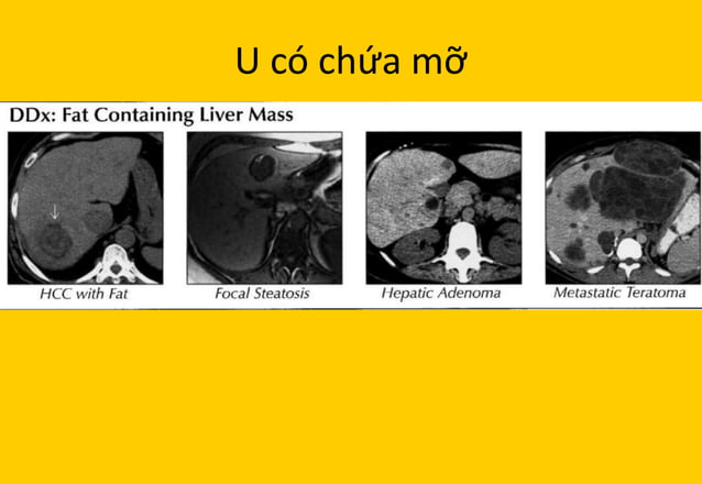 Clvt trong cđ u gan 2 | PPTX