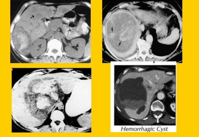 Clvt trong cđ u gan 2 | PPTX